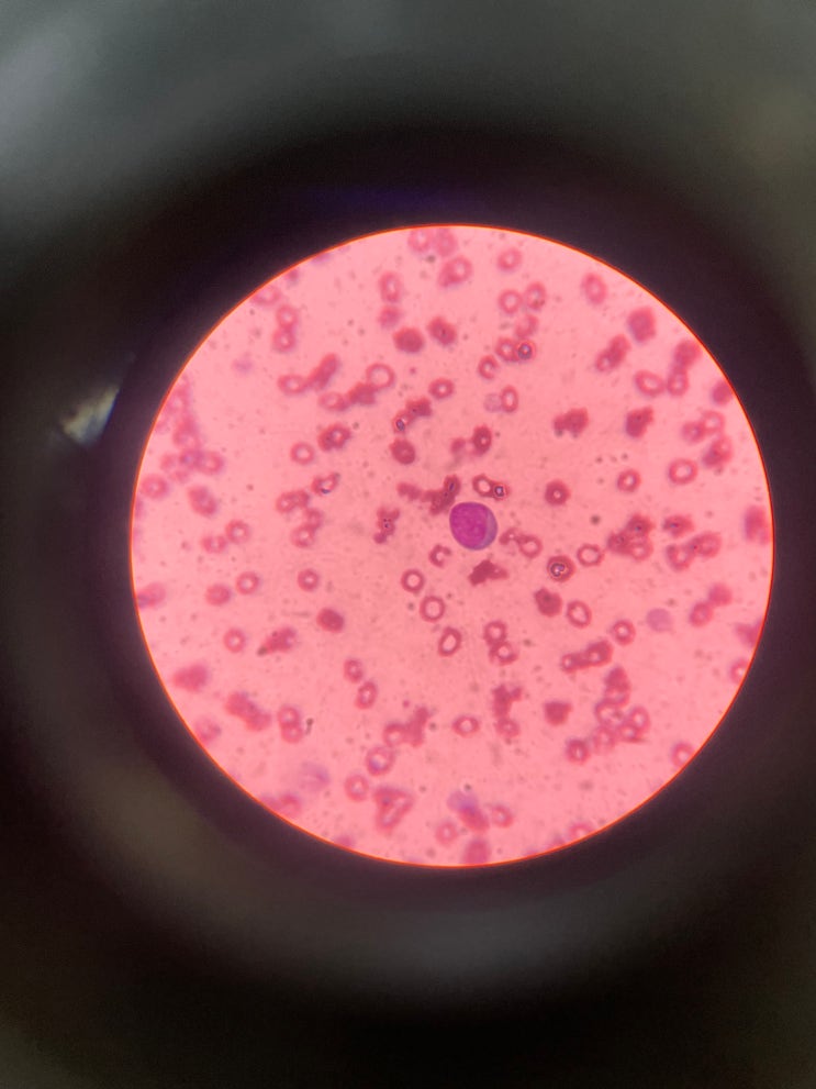 diff count blast cell form 혈청학적 사례 : 네이버 블로그