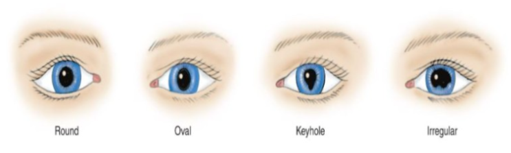 LOC, GCS, pupil reflex, Motor power : 네이버 블로그