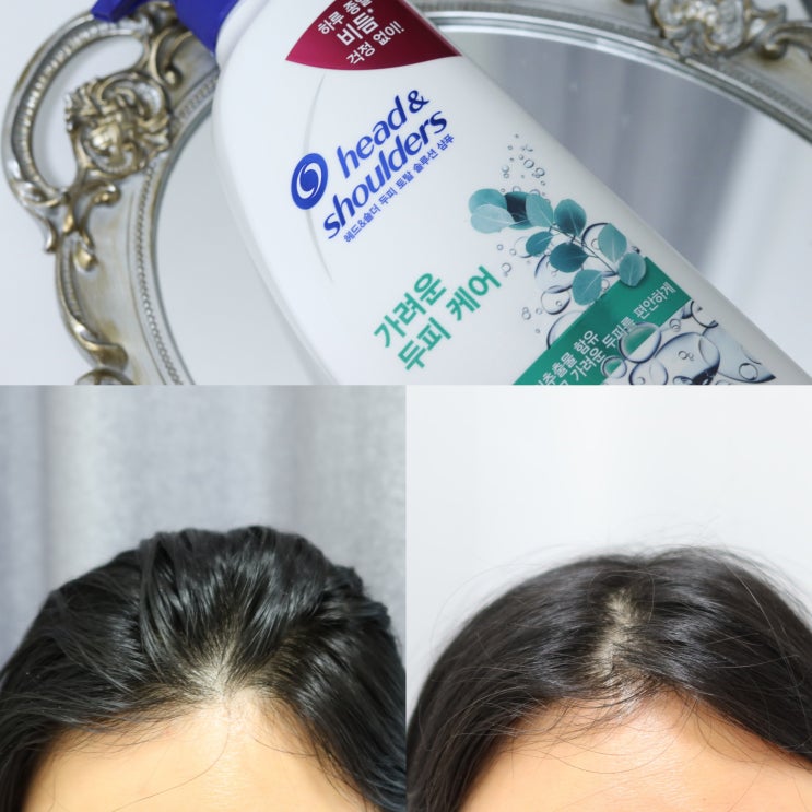 비듬샴푸추천 머리 비듬없애는법 헤드앤숄더샴푸 가려운 두피관리 후기 네이버 블로그