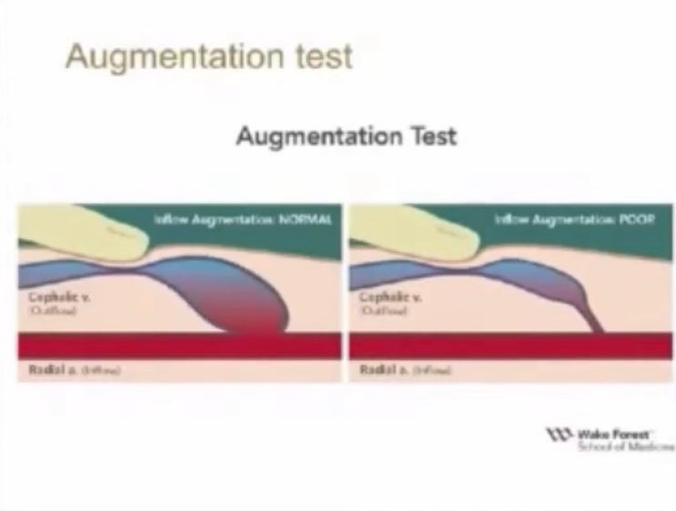 AVF, AVG 투석혈관의 이학적 검진/ arm elevation test, augmentation test : 네이버 블로그