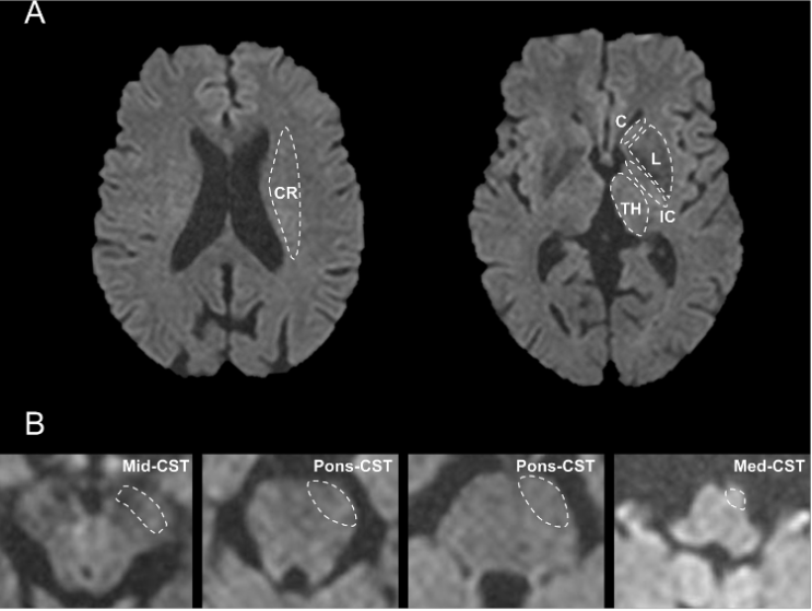 Cerebral infarction ( CR, IC, Thalamic,medulla, pons 포함 ) : 네이버 블로그