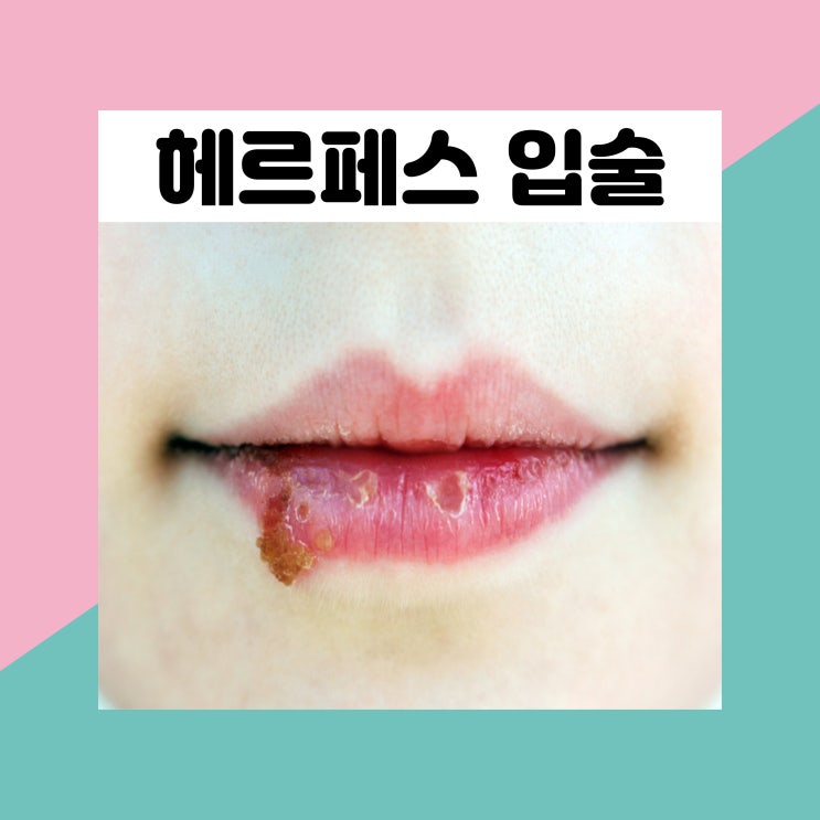 헤르페스 입술 성병 증상 전염 초기 입술포진 연고 1형 2형 증상 성병 네이버 블로그
