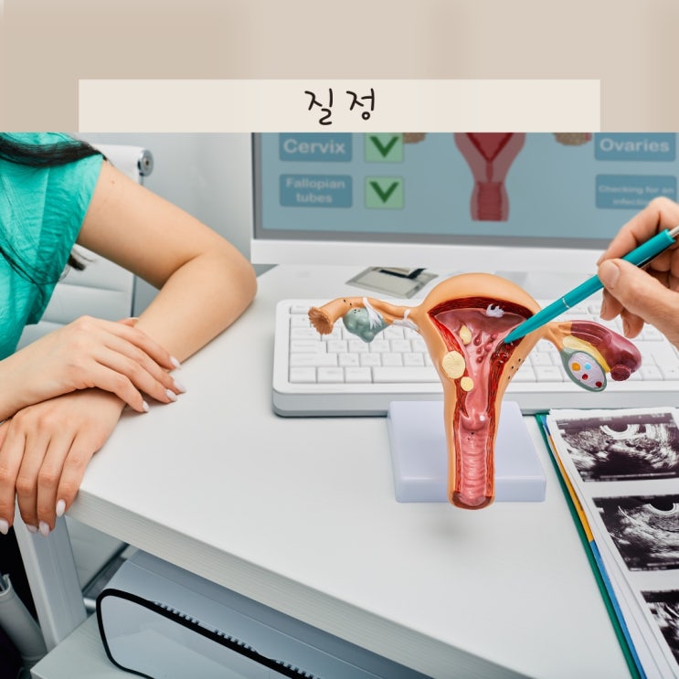 질정 효과 종류 넣는방법 녹는 시간 통증 부작용 찌꺼기 약국 칸디다질염 카네스텐 지노베타딘 세나서트 적응증 네이버 블로그