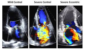 🫀Eccentric MR,AR 일때 추가적인 검사법 : 네이버 블로그