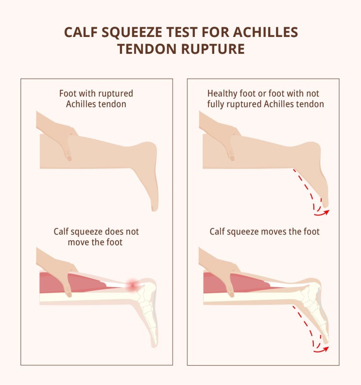Thompson Test(Achilles Tendon) : 네이버 블로그