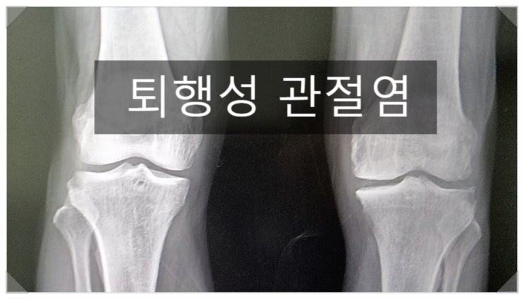 퇴행성 관절염 증상 원인 치료 손 무릎 퇴행성관절염 네이버 블로그