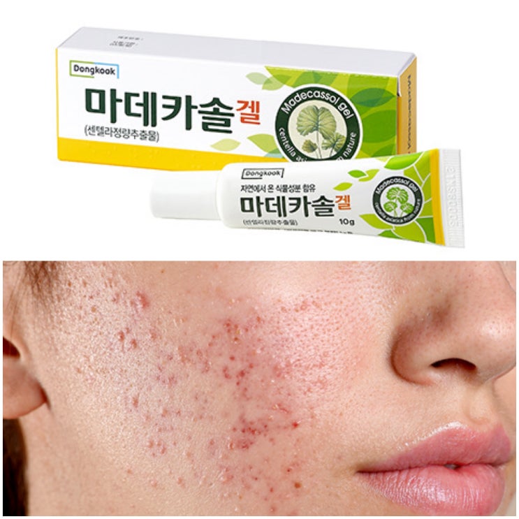 마데카솔겔 수분크림 여드름 연고 사용법 총정리 가격 효능 성분 파는곳 네이버 블로그