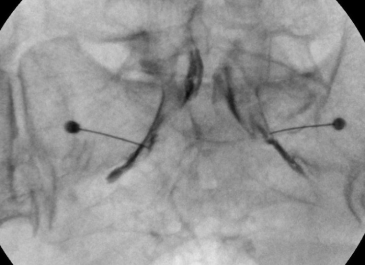 S1 root block, S1 TFESI, S1 transforaminal epidural steroid injection ...