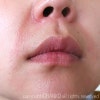 리도맥스 연고 로션 병원처방 사용법 And 후기 네이버 블로그