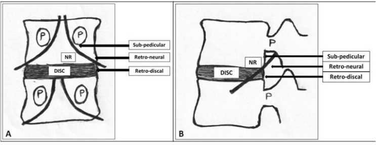 [재활/척추] 초음파를 이용한 요추부 약침 시술 - 2. SNRB(Nerve root block), SLTEB(Lumbar ...