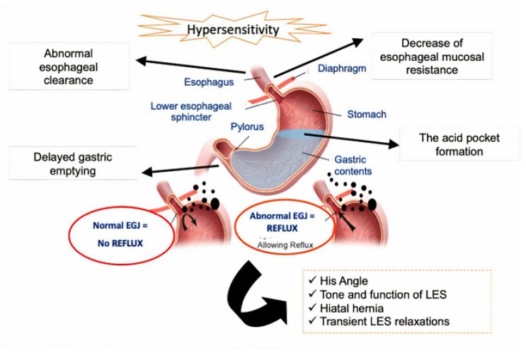 역류성 식도염의 증상과 관리(Management of Gastroesophageal Reflux) : 네이버 블로그