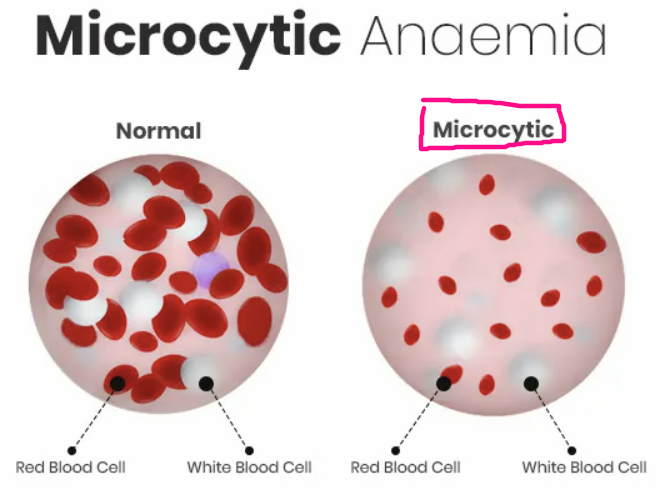 [USMLE review] microcytic anemia, 소적혈구빈혈 : 네이버 블로그
