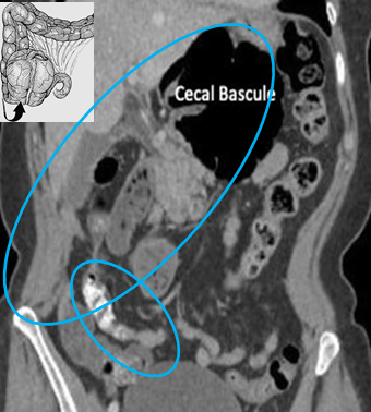 Case_Study_415: 3주간의 간헐적인 복통, 충만감, 변비를 주소로 내원한 65세 여성_맹장 소낭(Cecal ...