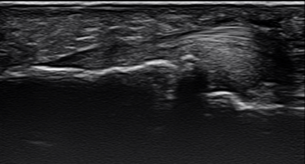 [손목] distal radius 골절 수술 후 delayed FPL rupture : 네이버 블로그