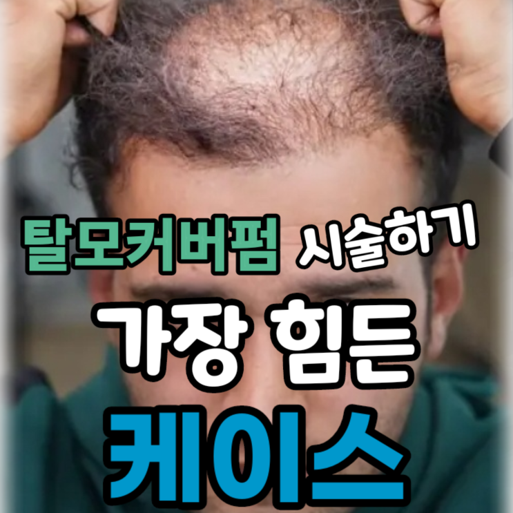 남자 탈모펌 탈모커버펌 시술이 가장 힘든 케이스 남자 탈모 파마 앞머리탈모 남자파마 극한직업탈모미용실 네이버 블로그