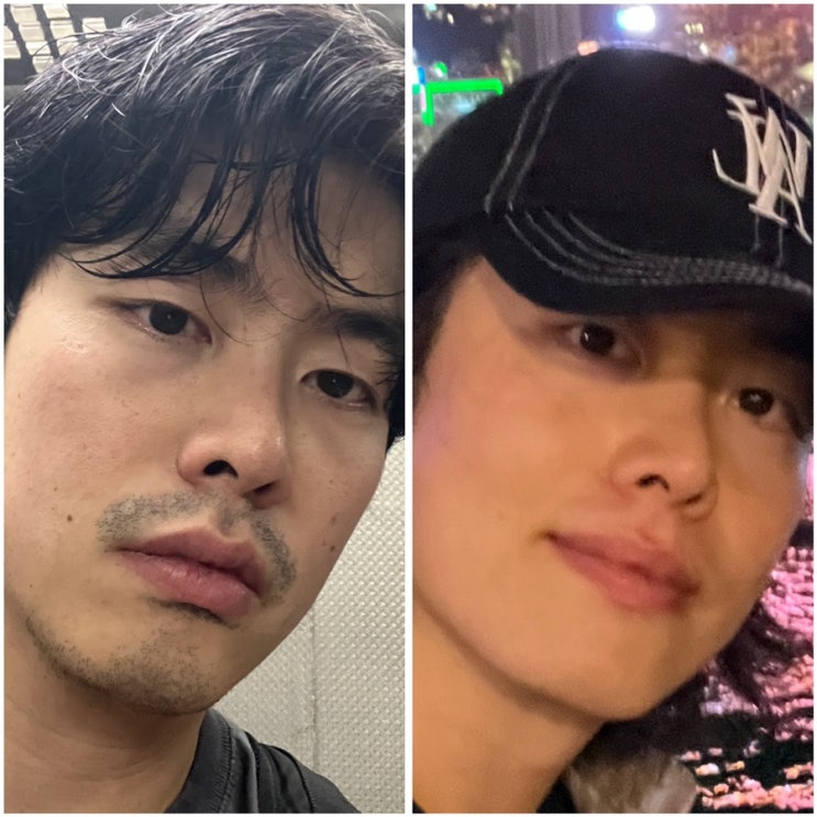 수염레이저제모 젠틀맥스프로플러스 수염제모성지 서울수염제모성지 홍대제모 홍대피부과과 무조건 추천하는 남자