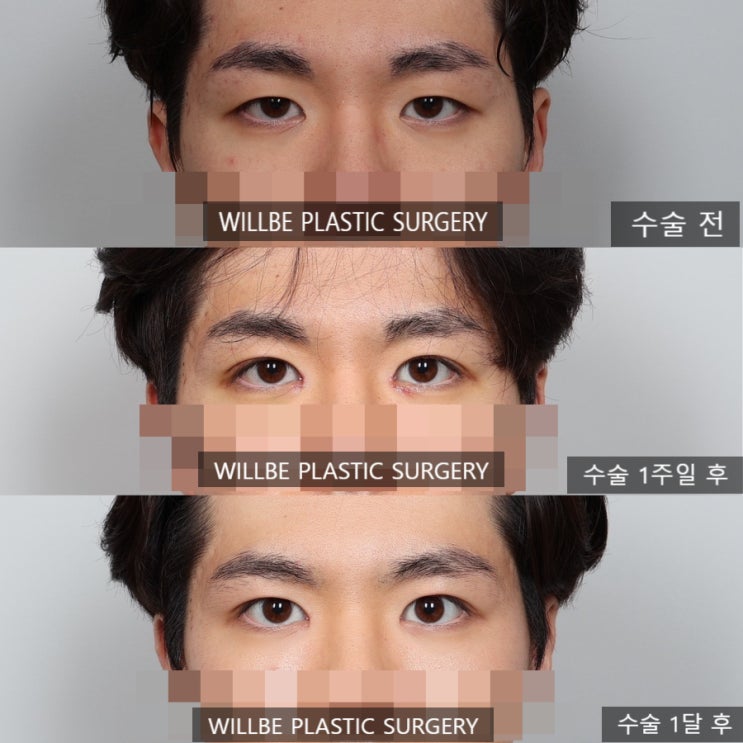 남자 비절개눈매교정 후기 전후사진 [윌비성형외과] : 네이버 블로그