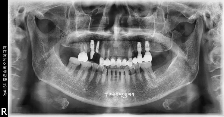 지대주(abutment)가 부러진 바이콘(bicon) 임플란트 픽스쳐 내부 지대주 제거 후 재보철 : 네이버 블로그