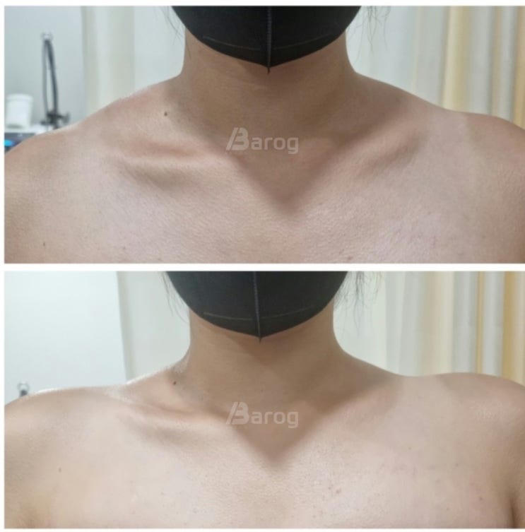 웨딩 전 넥라인관리 서면 승모근 보톡스 언제부터 효과있을까 네이버 블로그