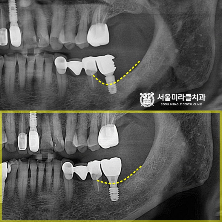 뼈가 이렇게나 많이 녹았다고 군포 치과 70대 임플란트 재수술 증례🦷 네이버 블로그
