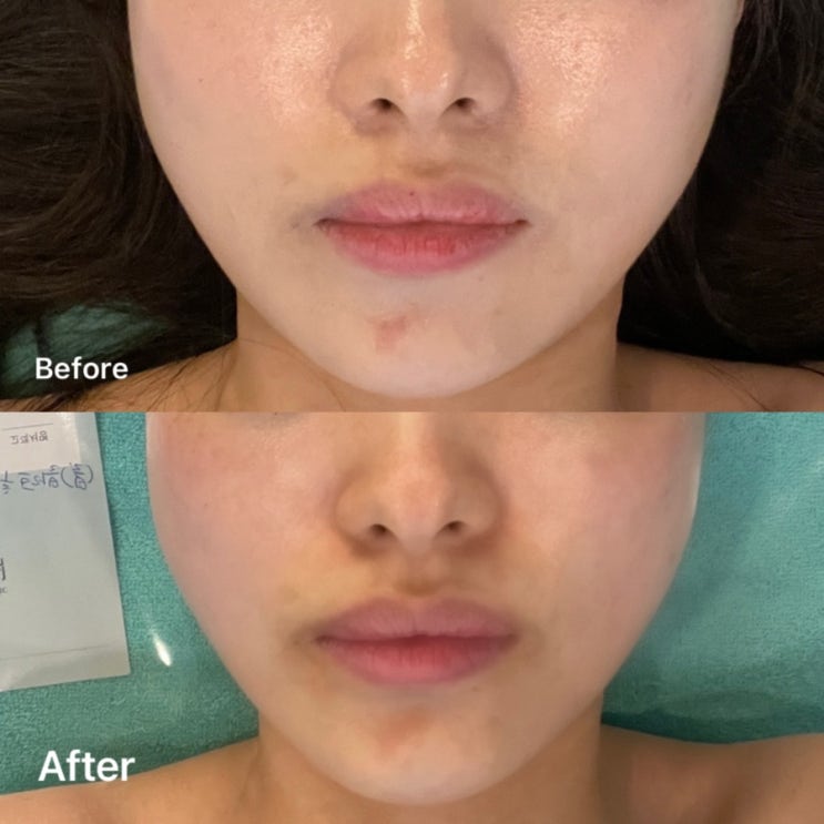 해운대 피부관리 고운빛깔 센텀점 작은 얼굴과 비대칭 관리 받고 왔어요 네이버 블로그