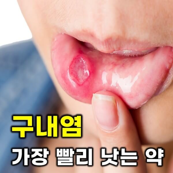 구내염 가장 빨리 낫는 방법 입병 자주 생기시는 분들 주목 약사 추천 약은 알보칠 아님 오라메디아님 네이버 블로그