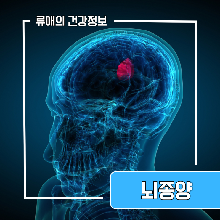 악성 뇌종양 초기증상 원인 치료 생존율 뇌종양에좋은음식 네이버 블로그