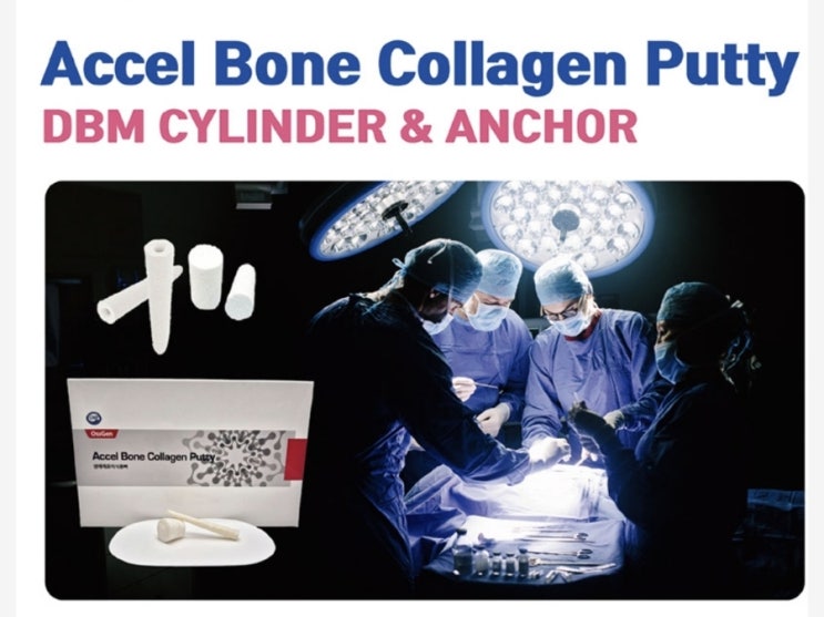 Accel Bone Collagen Putty DBM Cylinder/Anchor 생체재료이식용뼈 : 네이버 블로그