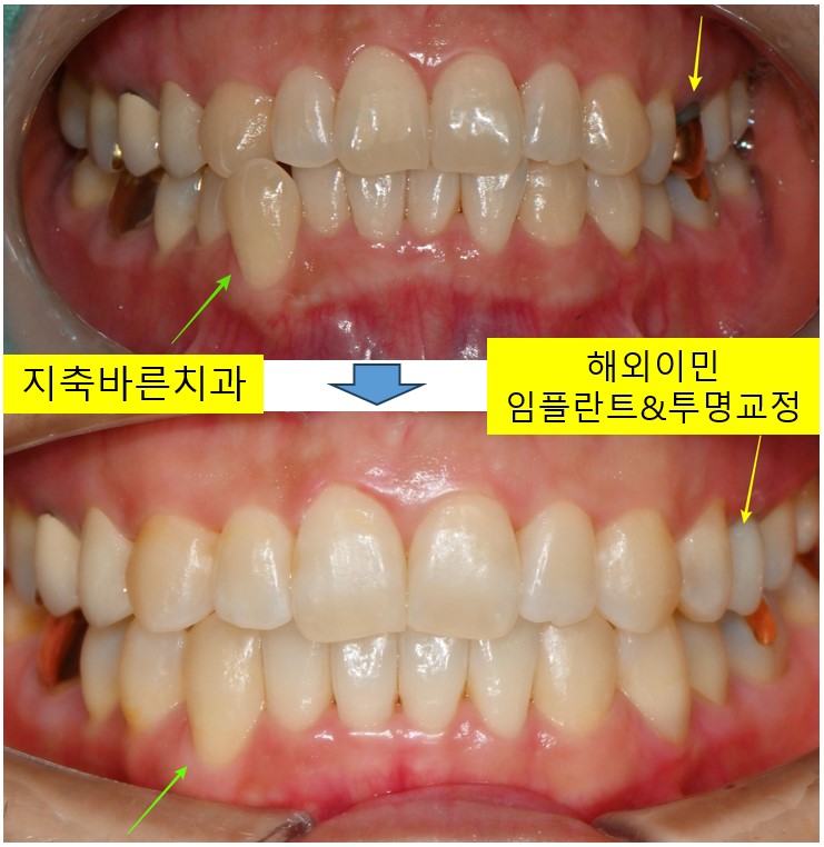 광화문치과 해외출국으로 덧니 투명교정 치료임플란트 식립 지축치과 지축역치과 삼송치과 지축투명교정 여의도치과 원흥치과 원당치과