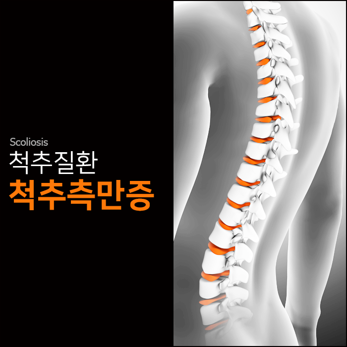 척추측만증 청소년척추질환 허리디스크 허리통증 서울신정형외과 네이버 블로그