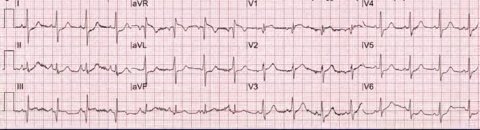 심전도 : PE associated with hemodynamic instability : 네이버 블로그