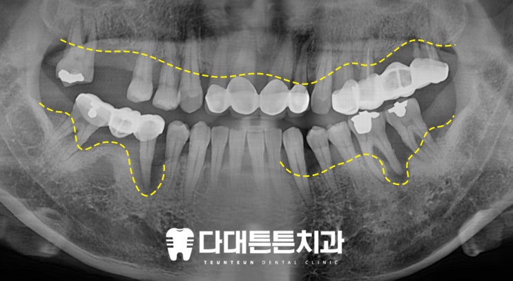 부산괴정치과 염증으로 인한 심한 치조골 소실 뼈이식을 동반한 임플란트 케이스 네이버 블로그