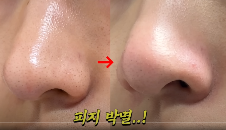 블랙헤드없애는법얼굴 코 딱딱한 피지제거 피지관리템 3종 소개 코팩 추천 네이버 블로그