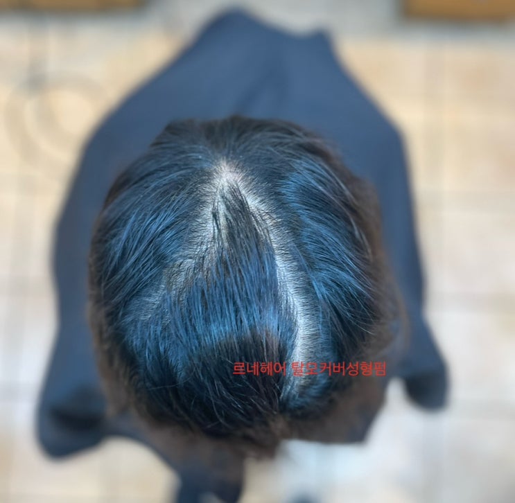 여성탈모 가르마갈라짐 모류교정 시술성지 부산사상르네시떼6층헤어샵 김해대저화명덕천모라하단백양명지다대감전주례덕포괘법당감개금부전