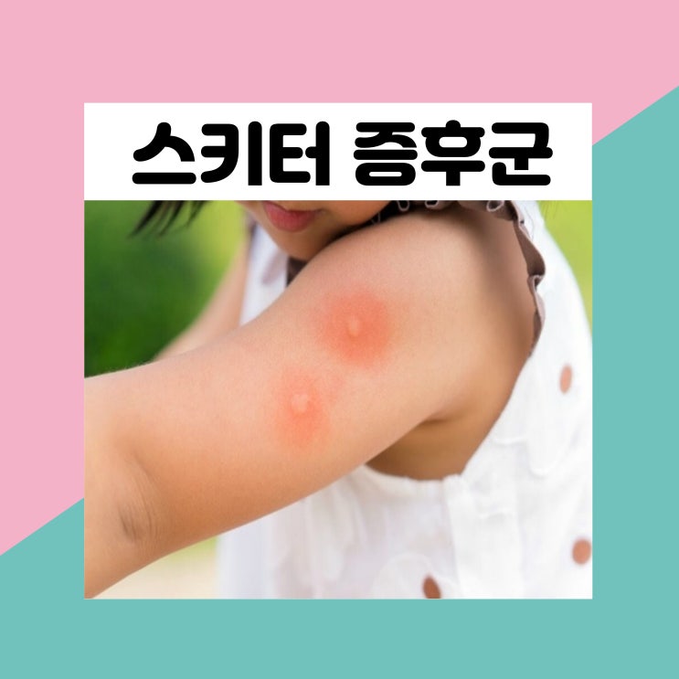 스키터 증후군 병원가기전 성인 아기 모기 알레르기 모기물렸을때 연고 약 알아보기 네이버 블로그