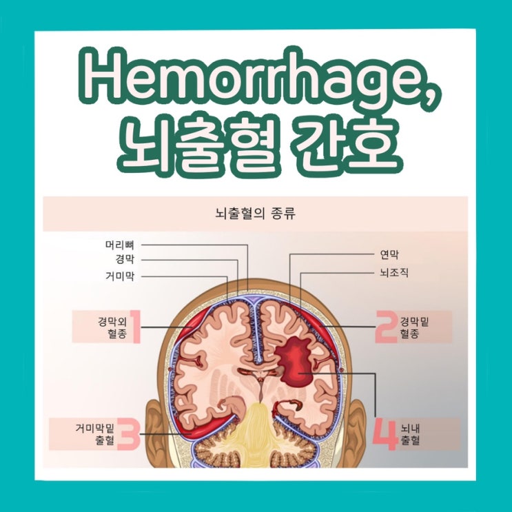 [응급실 간호] cerebral hemorrhage - 뇌출혈 (EDH,SDH,SAH,ICH) 종류 및 증상과 간호 : 네이버 블로그