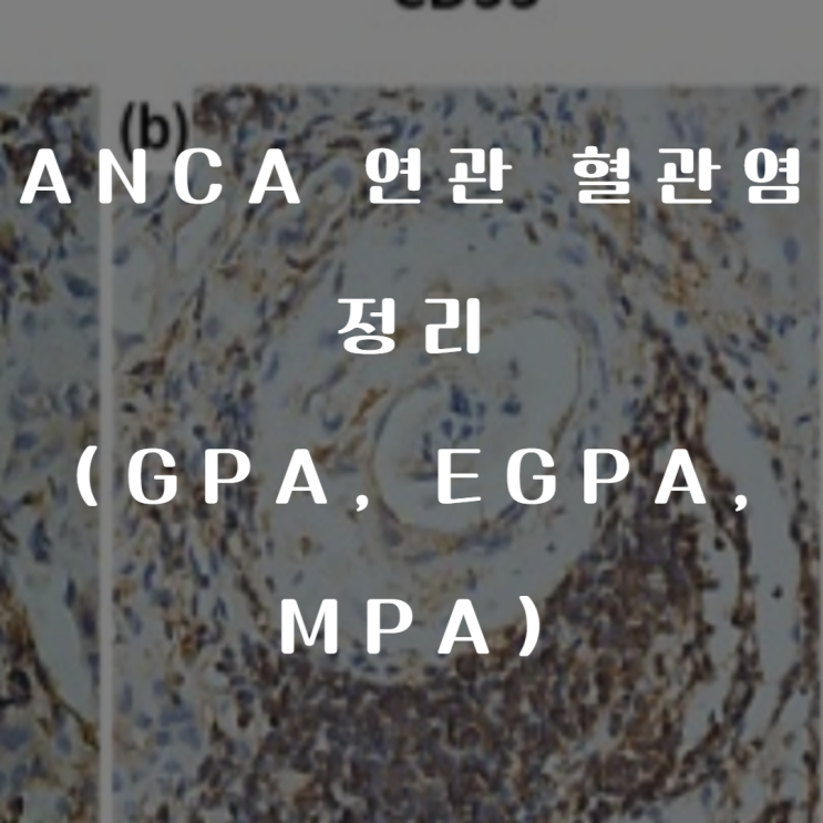 1. 척스트라우스(EGPA), 베게너육아종증의 분류 방법과 치료법 : 네이버 블로그
