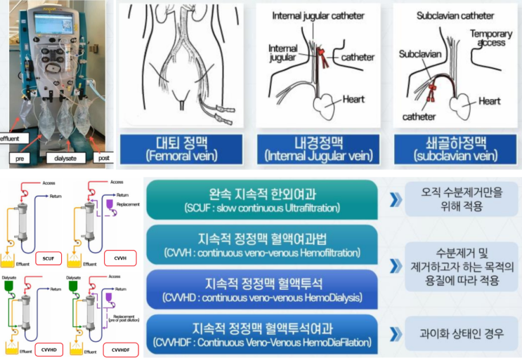 지속적 신대체요법(CRRT)의 카테터 및 CRRT solutions, 적용모드 : 네이버 블로그