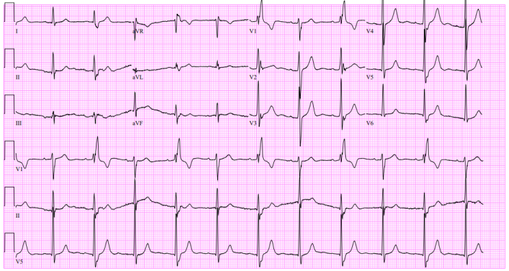 PVC와 aberrant conduction(그리고 RBBB?) : 네이버 블로그