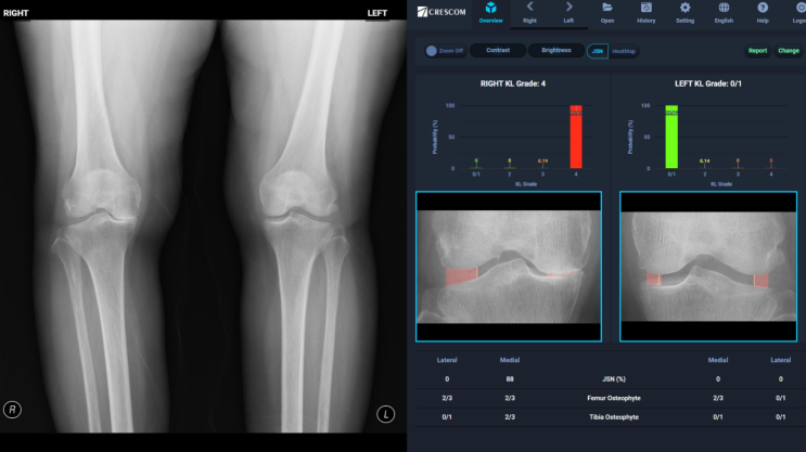 무릎 퇴행성관절염의 여러가지 분류 (OA grading system) 'K-L grade, Ahlback ...