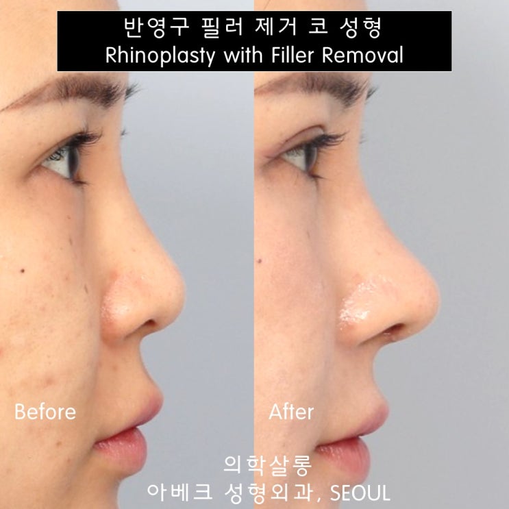 콧대 반영구필러 제거하고 싶어요 필러 제거 코수술 사례 【dr 아베크 코성형】 네이버 블로그