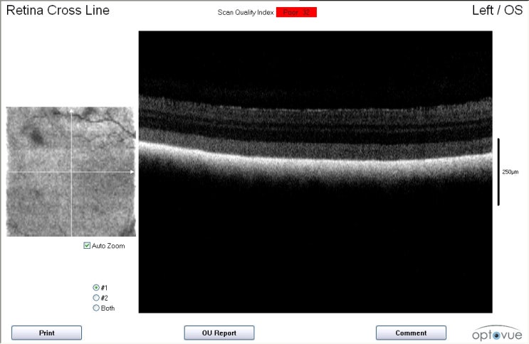 시신경염 (OPTIC NEURITIS), 시력 저하, 시력상실, OCT (Optical Coherence Tomography ...