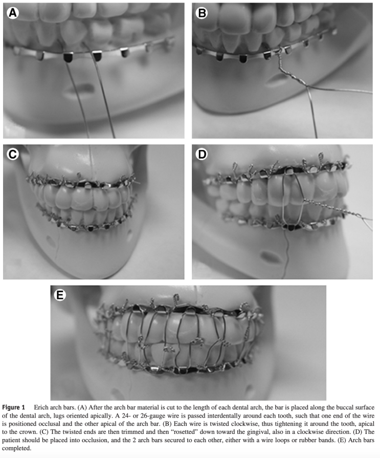 IMF, MMF, Intermaxillary fixation 이름의 기원 : 네이버 블로그