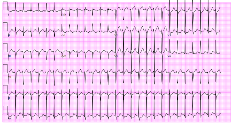 PSVT(paroxysmal supra ventricular tachycardia) 그리고 WPW SD(Wolf ...