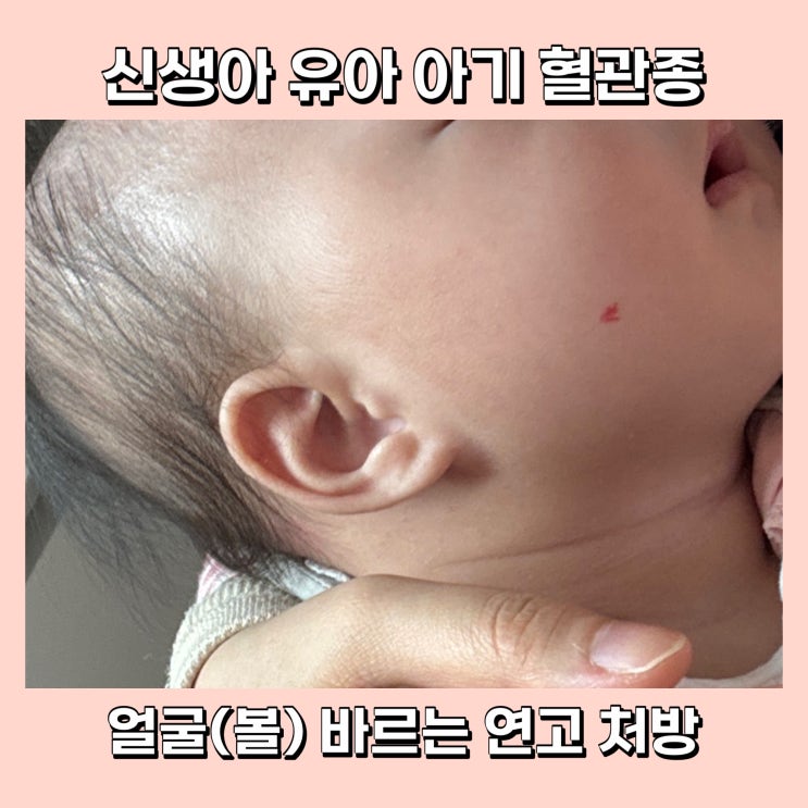 신생아 아기 유아 얼굴 혈관종 바르는 연고 처방 일산 백병원 네이버 블로그