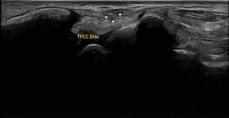 TFCC 증상 파열을 진단하는 기준과 치료 방법 : 네이버 블로그