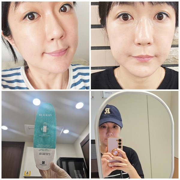 강남역 미술관 피부과 리쥬란힐러 2cc 크라이오셀 스킨부스터 내돈내산 후기 네이버 블로그