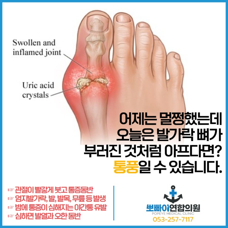 아침에 일어났는데 엄지발가락이 부러진 것처럼 아프다고요 통풍 관절염 발작이라면 빨리 병원에 가셔서 치료 받으세요뽀빠이연합