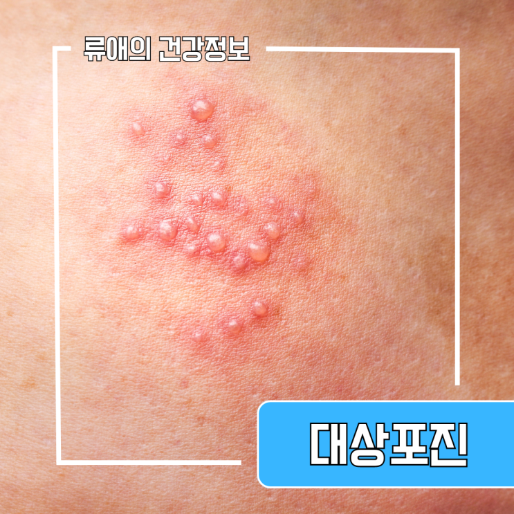 대상포진 초기증상 및 원인 치료 대상포진에좋은음식 네이버 블로그