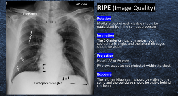 [영상의학과 검사/간호] 영상의학과 검사 1탄 (방사선? / Chest x-ray 보는법 / Chest AP vs PA ...